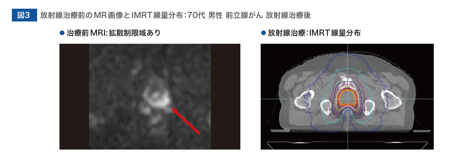 前立腺がんにおけるPSMA-PET検査の有用性 - 宇都宮セントラルクリニック 放射線治療センター