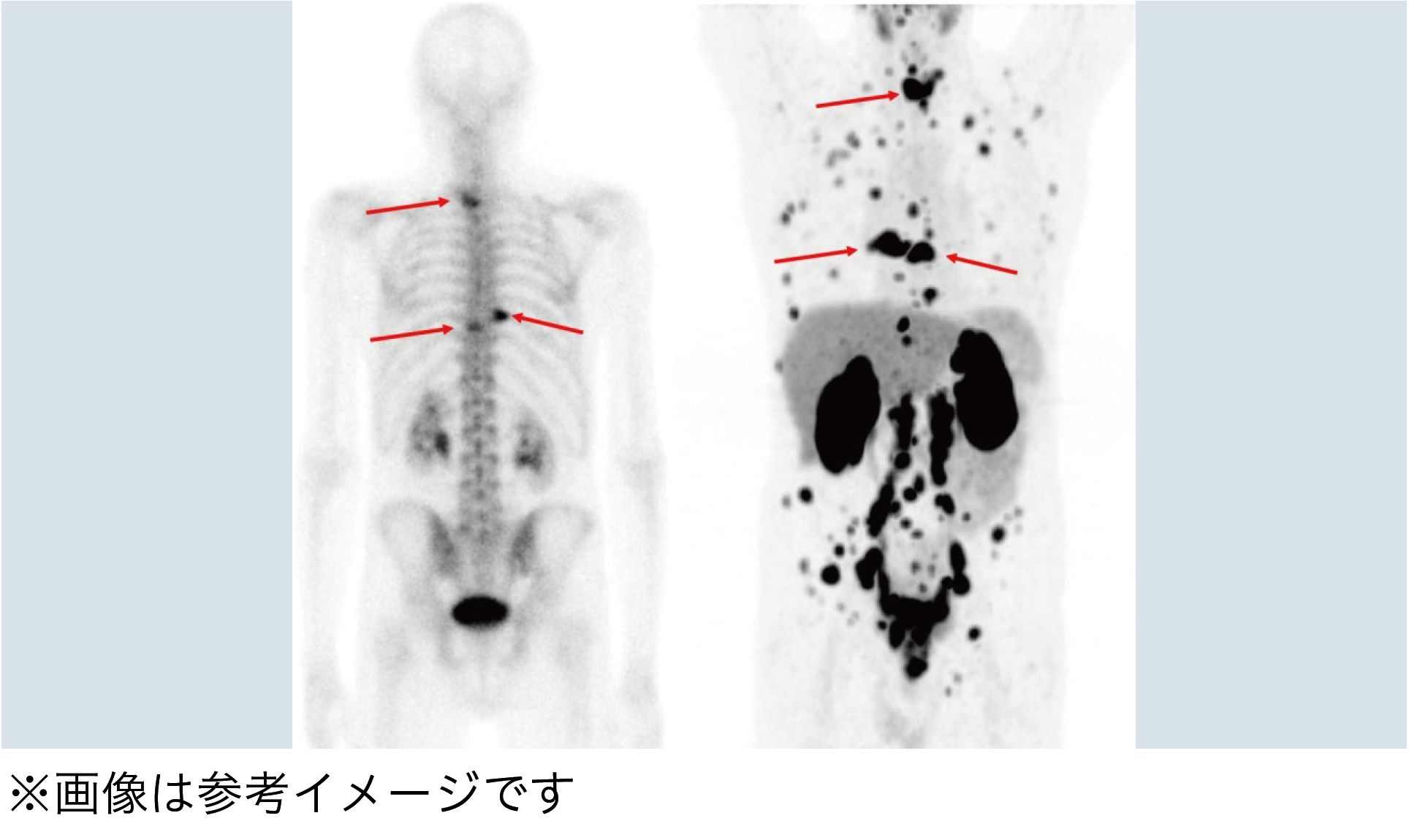 前立腺癌におけるPSMA-PETを用いたオリゴ転移の発見と放射線治療の有用性 - 宇都宮セントラルクリニック 放射線治療センター